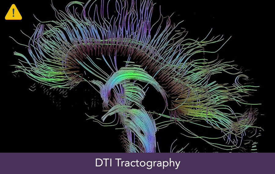 DTI and Concussions - The Concussion Group DTI and Concussions - The Concussion Group